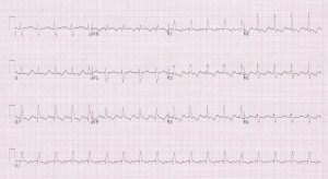 EKG Examples | Torrey EKG