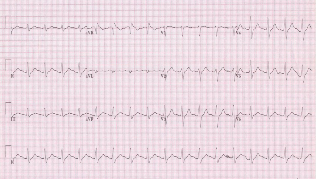EKG Examples | Torrey EKG
