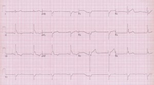 EKG Examples | Torrey EKG