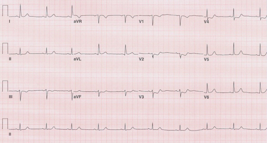 EKG Examples | Torrey EKG