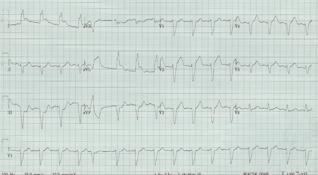 EKG Examples | Torrey EKG