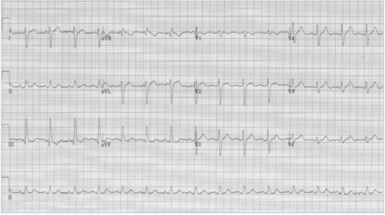 Torrey EKG